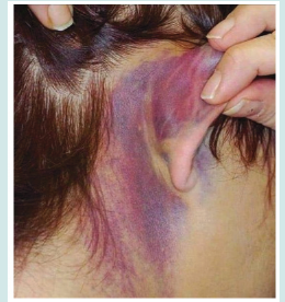 Battle´s Sign. More than a Manifestation of Head Trauma