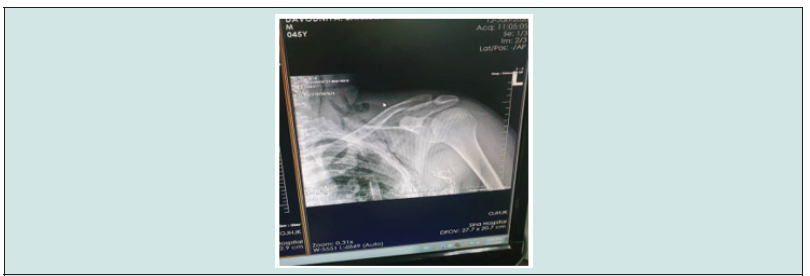 Brachial Plexus Reconstruction Following Textiloma Due to Subclavian ...