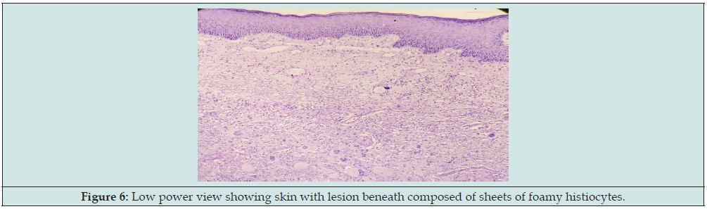 Bilateral Axillary Multiple Tuberous Xanthomas – A Rare Case Report